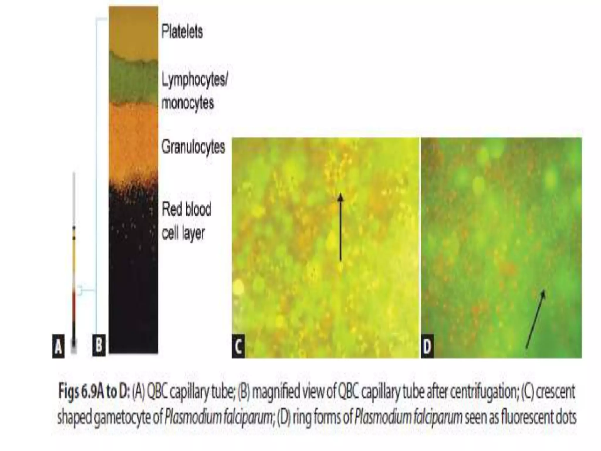 Diagnosis & blood stages of malaria . | PPTX