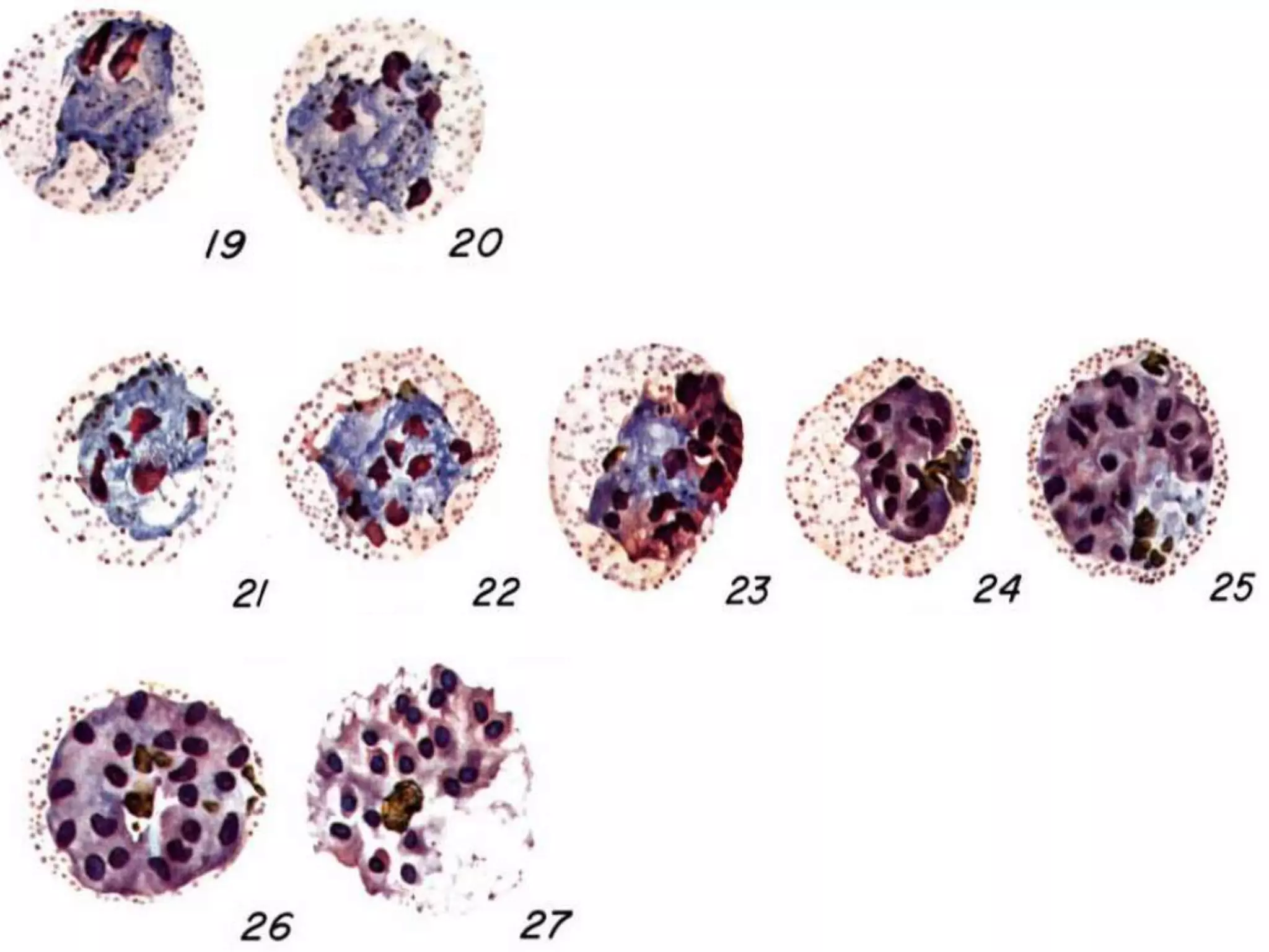 Diagnosis & blood stages of malaria . | PPTX