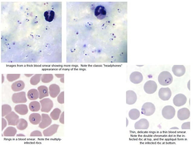 Diagnosis & blood stages of malaria . | PPTX | Infectious Diseases ...