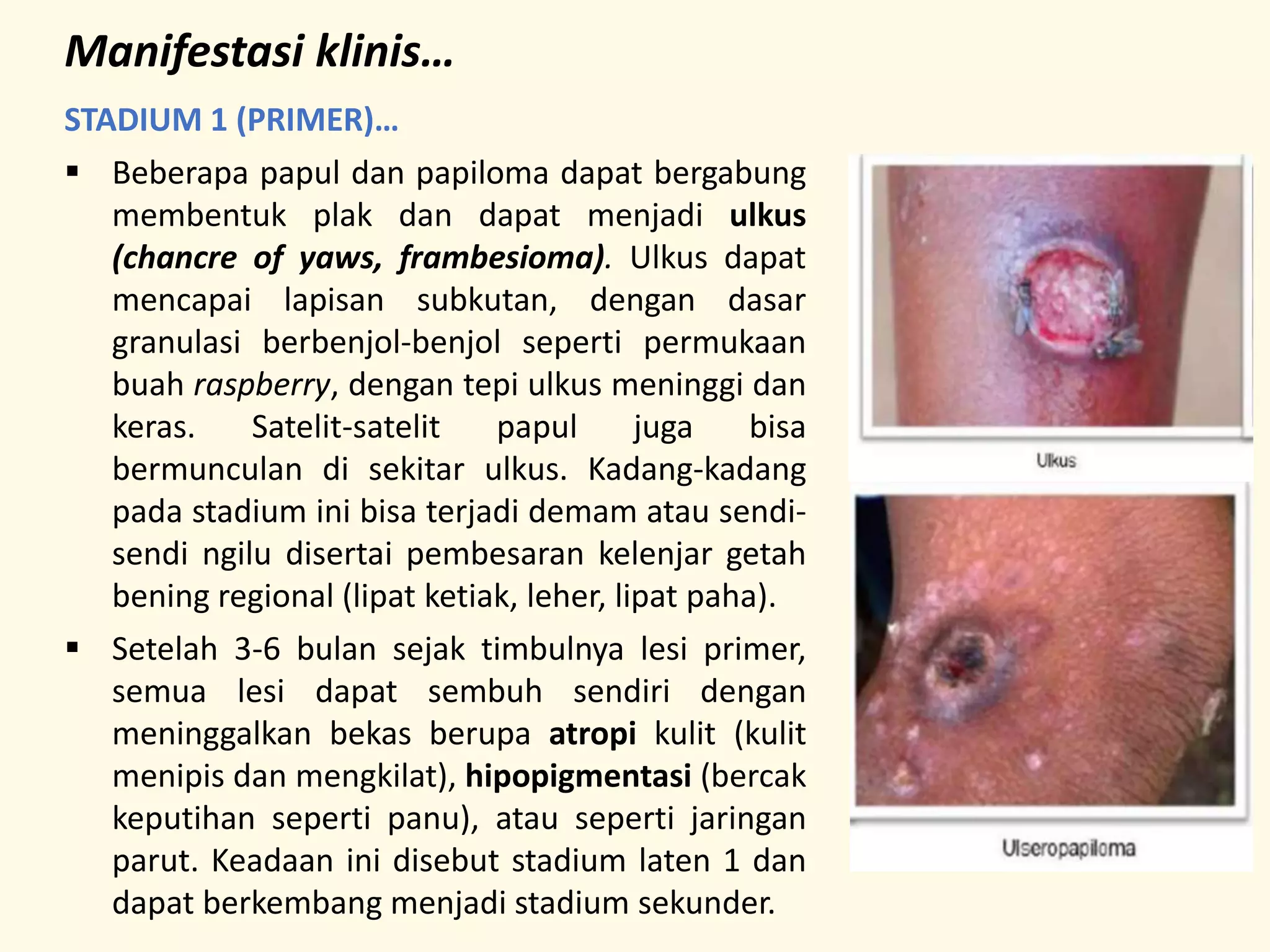 Diagnosis dan Tatalaksana Frambusia.ppsx