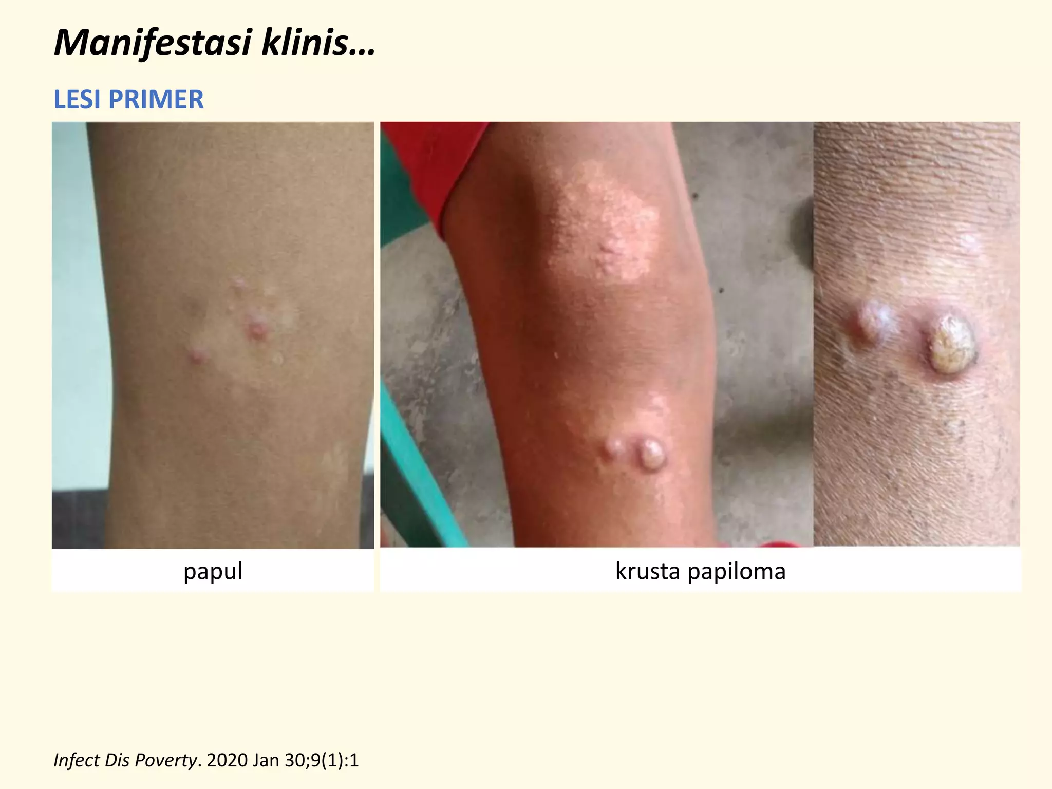 Diagnosis dan Tatalaksana Frambusia.ppsx