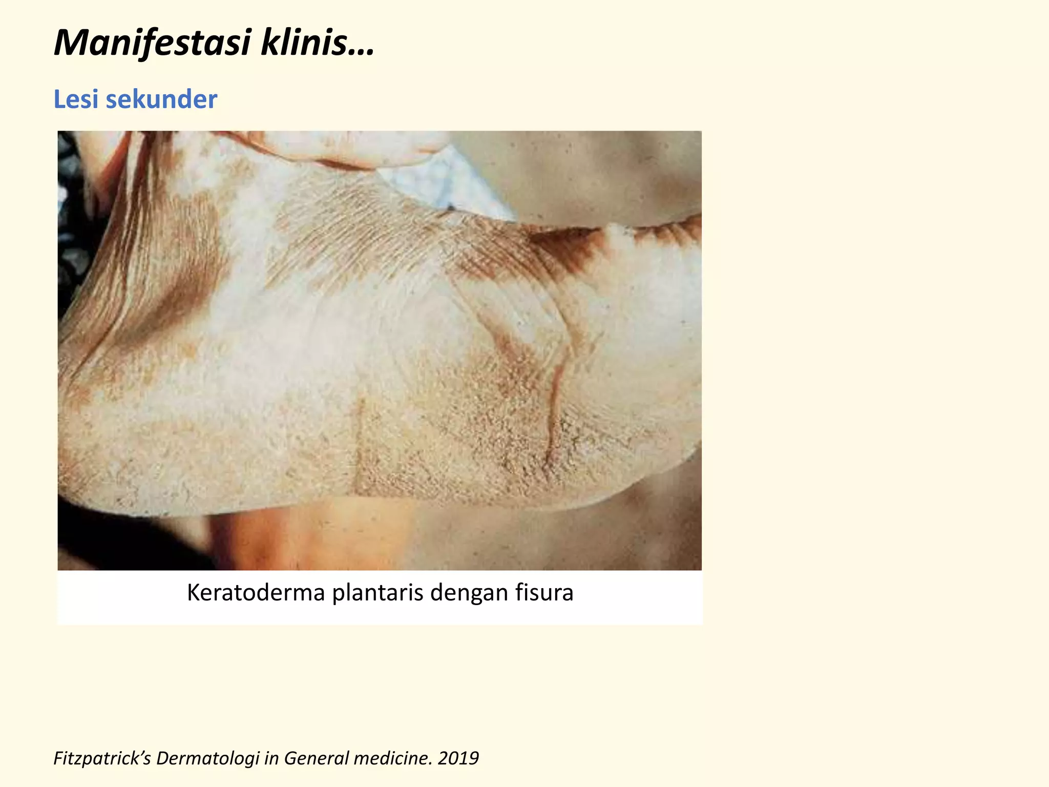 Diagnosis dan Tatalaksana Frambusia.ppsx