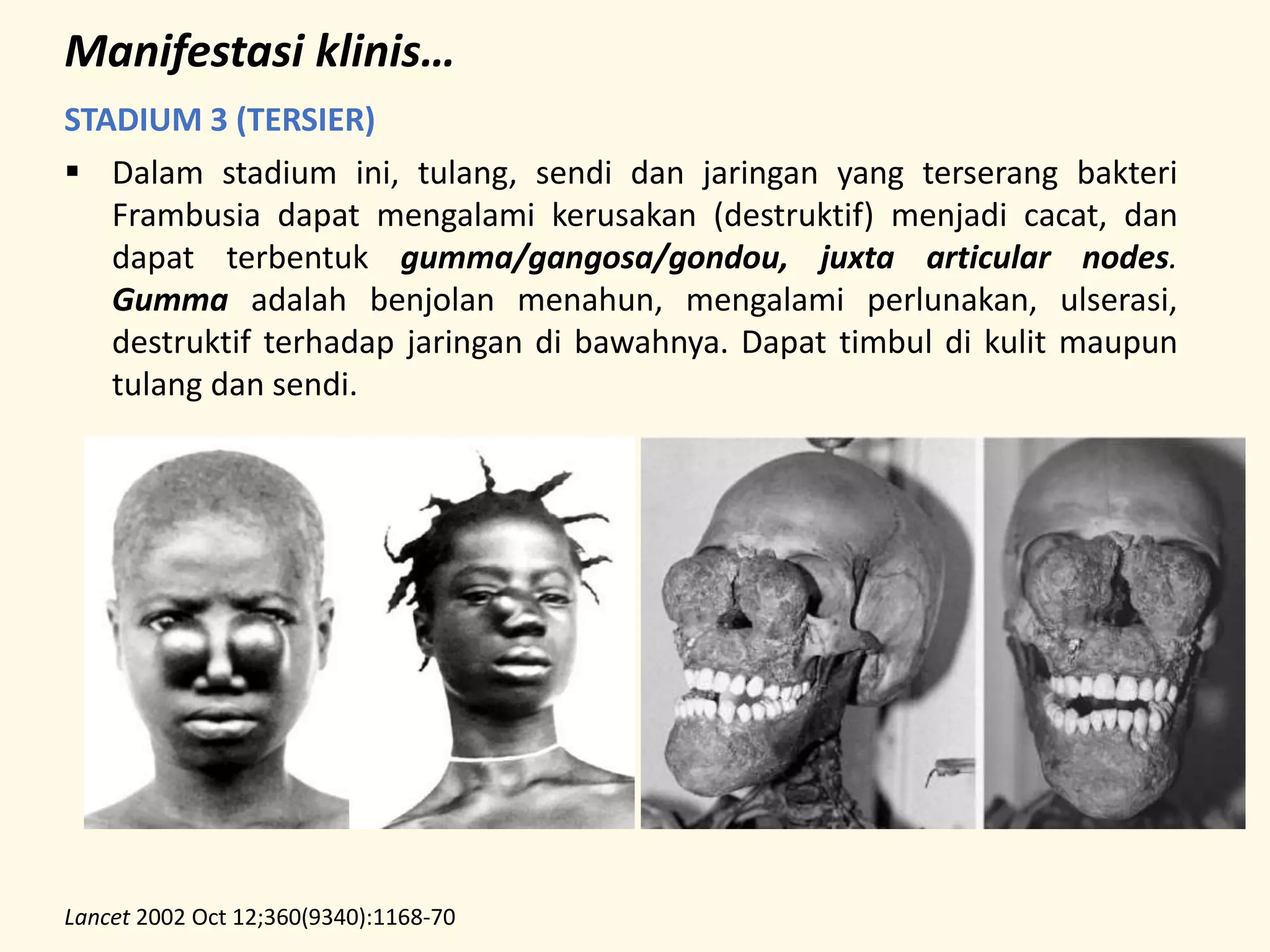 Diagnosis dan Tatalaksana Frambusia.ppsx