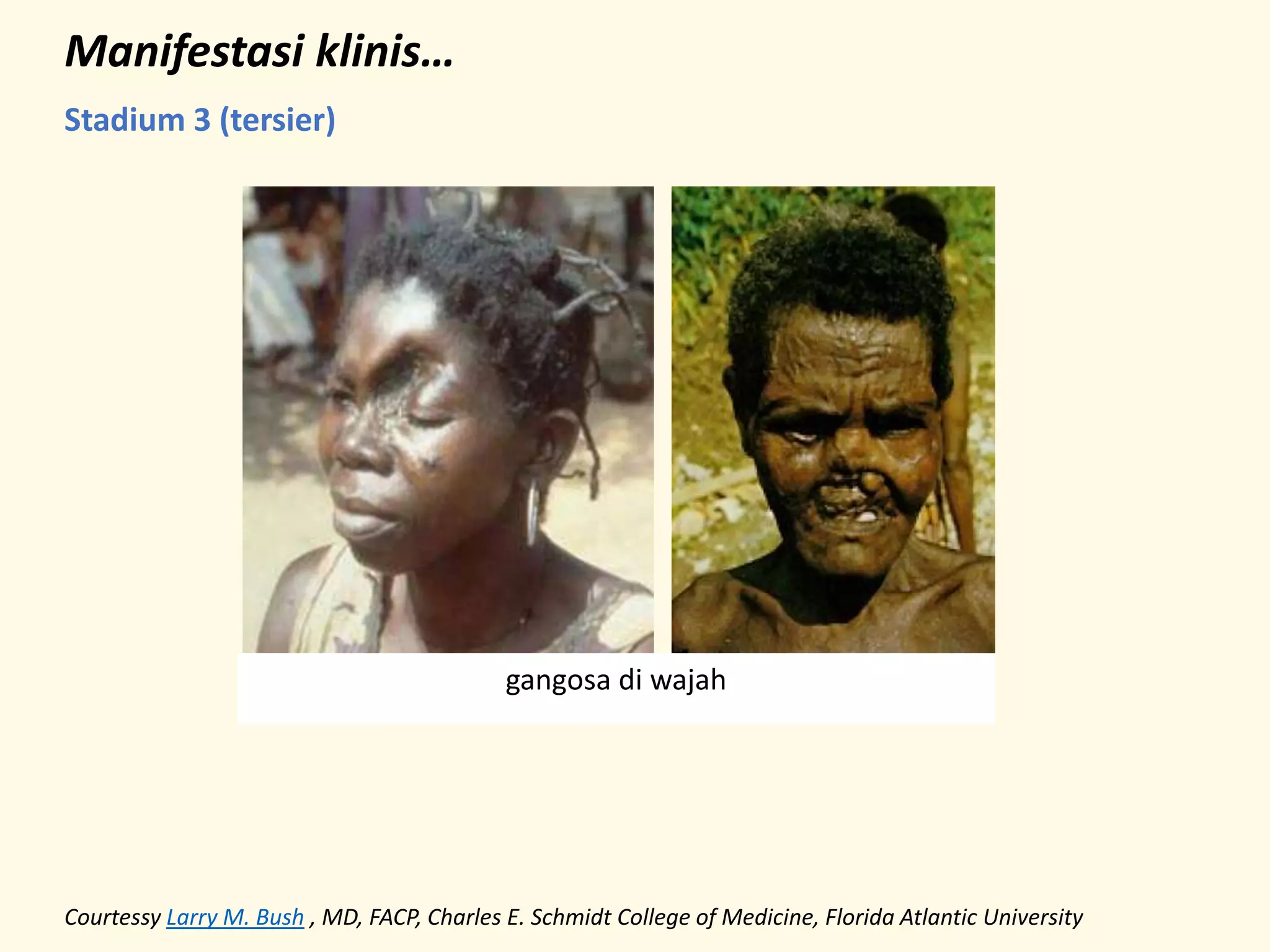 Diagnosis dan Tatalaksana Frambusia.ppsx