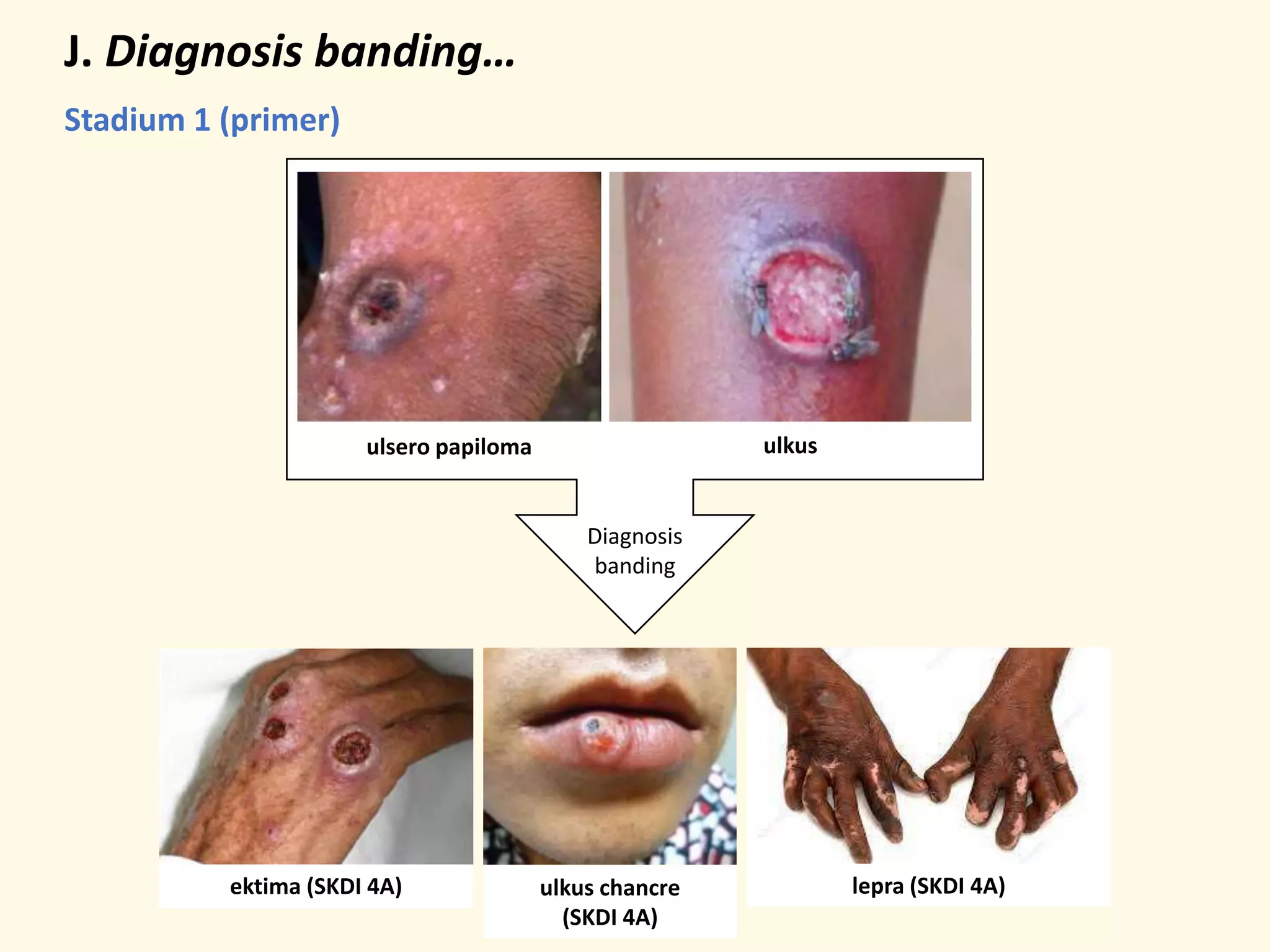 Diagnosis dan Tatalaksana Frambusia.ppsx