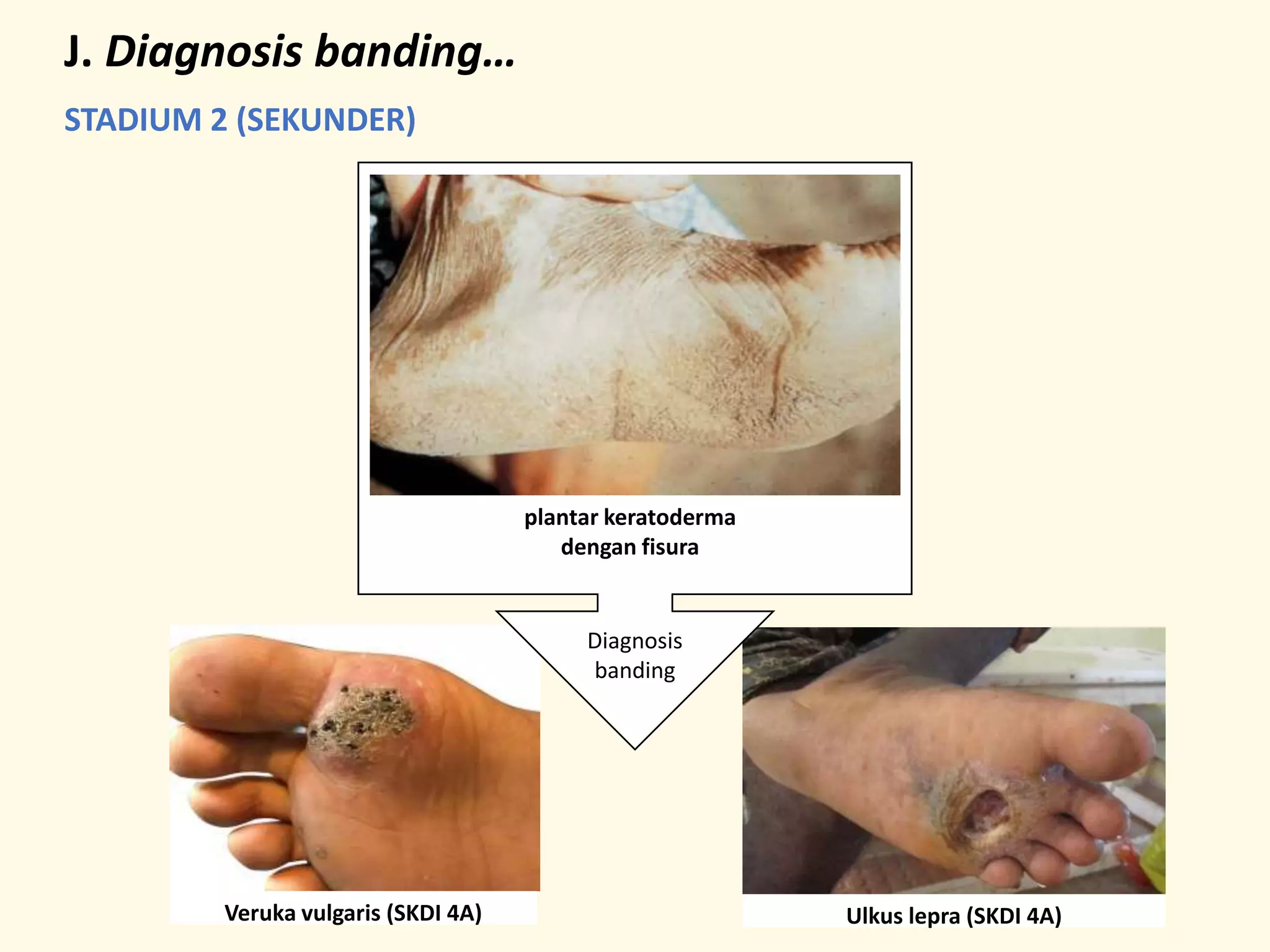 Diagnosis dan Tatalaksana Frambusia.ppsx