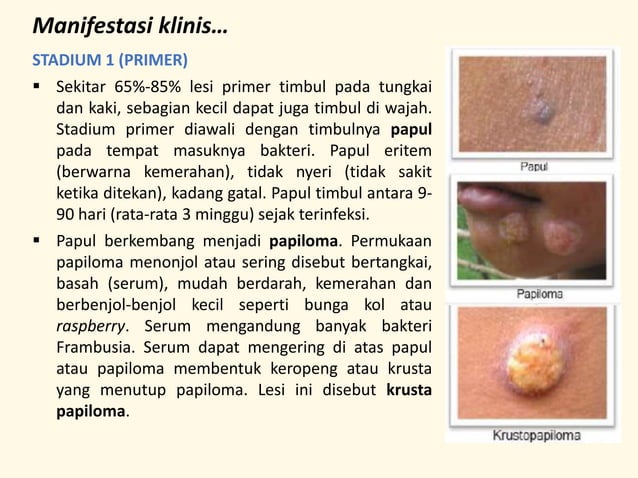 Diagnosis dan Tatalaksana Frambusia.ppsx