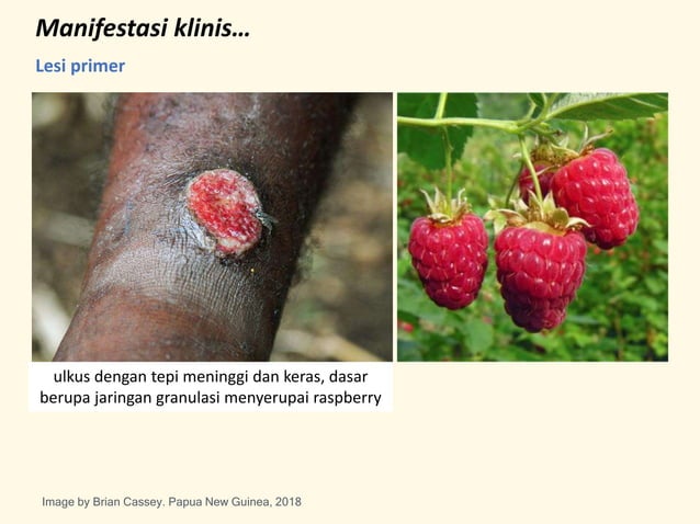Diagnosis dan Tatalaksana Frambusia.ppsx