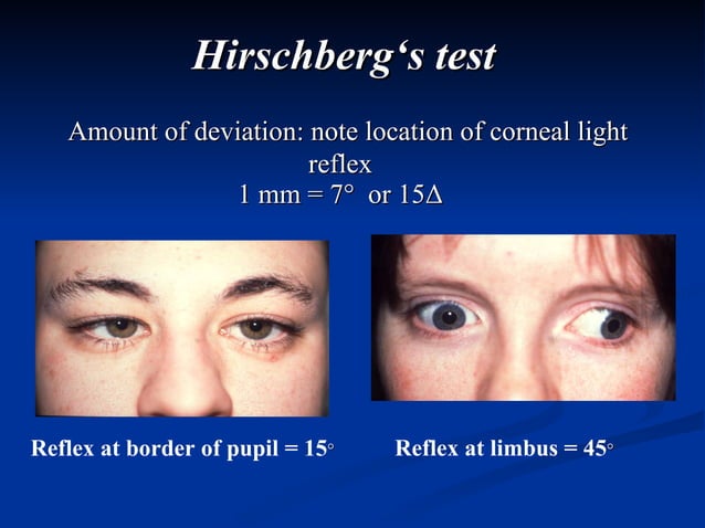 Diagnosis evaluation in strabismus | PPT