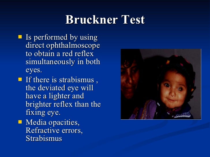 Diagnosis evaluation in strabismus