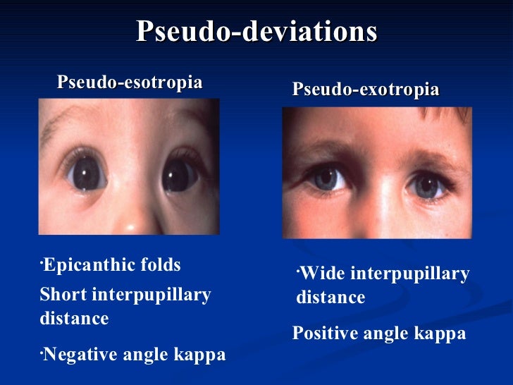 Diagnosis evaluation in strabismus