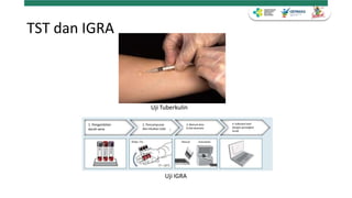 Diagnosis ILTB terapi dan monitoring TPT Fix.pptx