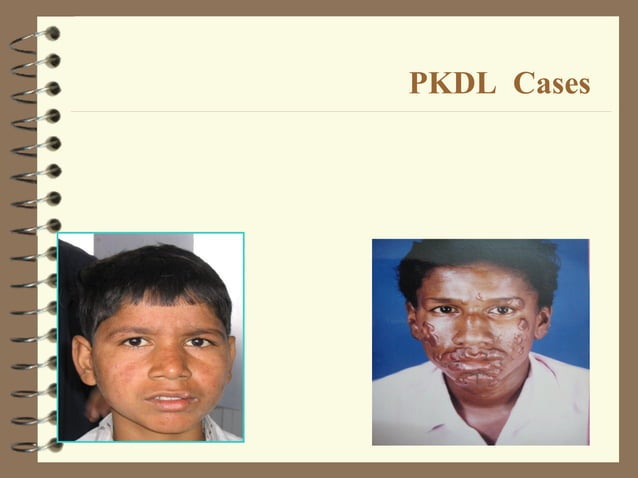 Diagnosis ka pkdl by dr shahjada_selim | PPT | Skin and Dermatology ...