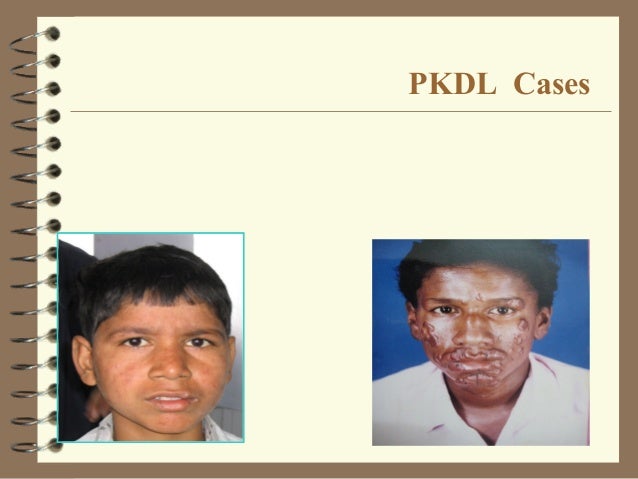 Diagnosis ka pkdl by dr shahjada_selim