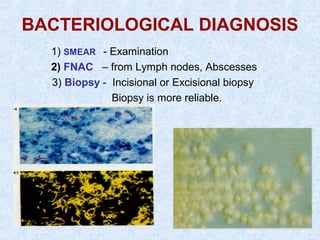 Diagnosis & management of tb in RNTCP | PPT