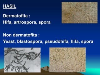 DIAGNOSIS MIKOSIS SUPERFISIALIS.ppt