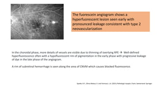 Diagnosis Myopic Neovascularization.pptx