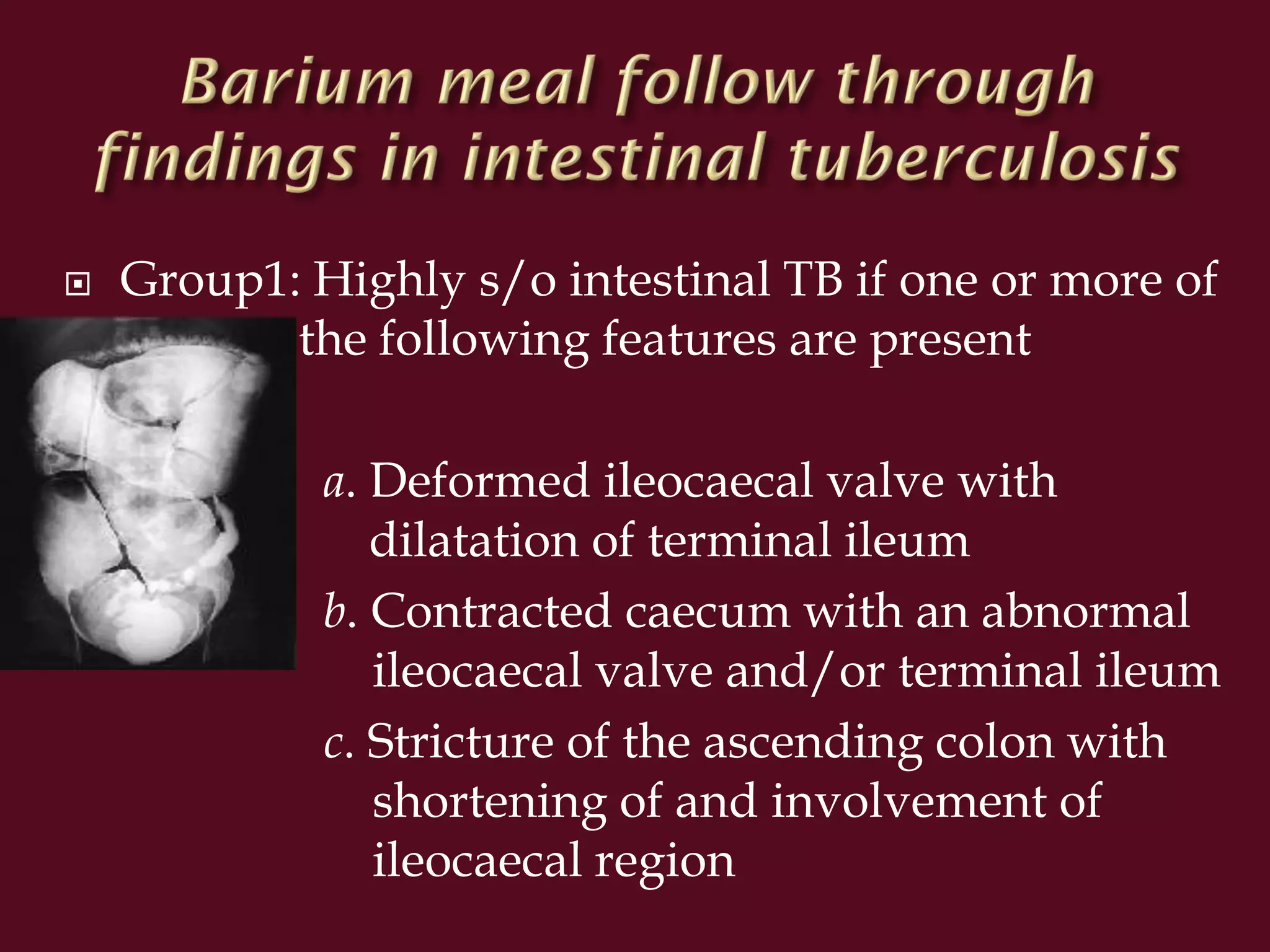Diagnosis of abdominal tuberculosis | PDF | Digestive Disorders ...