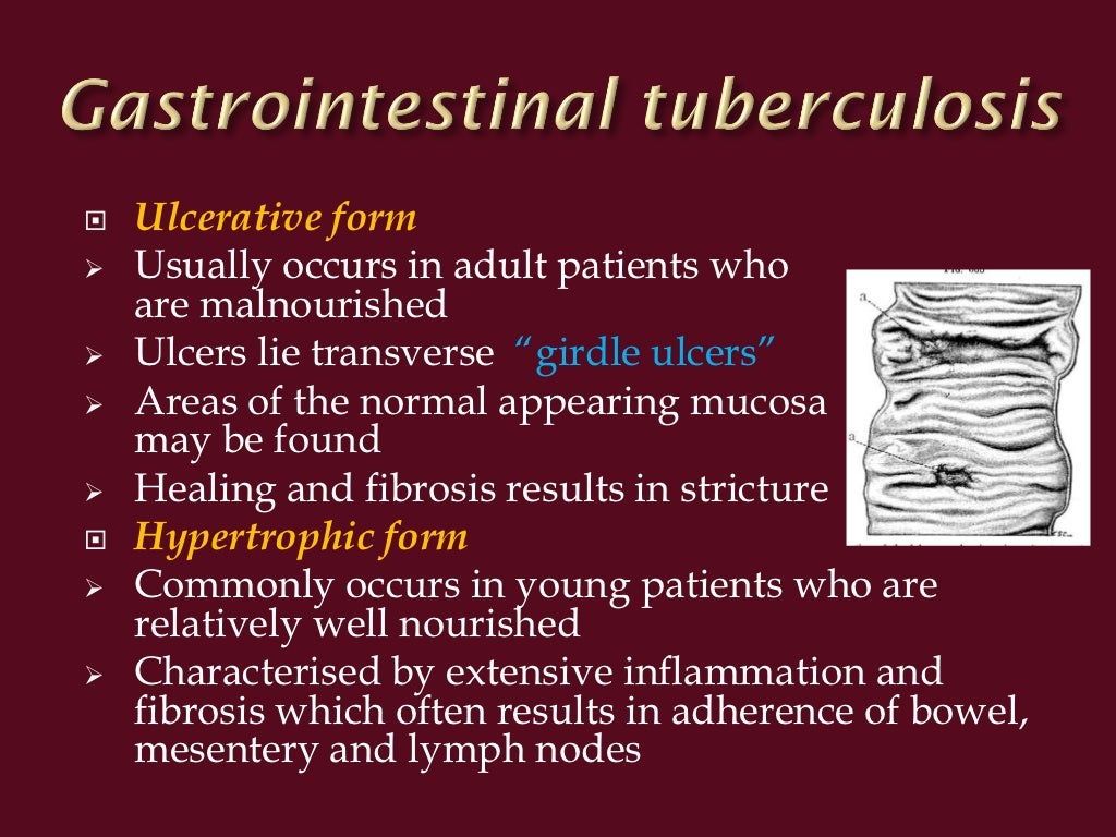 Diagnosis of abdominal tuberculosis