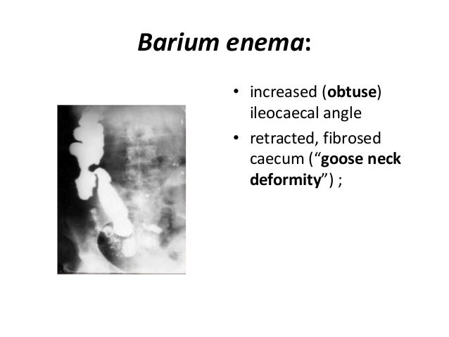 Diagnosis of abdominal tuberculosis