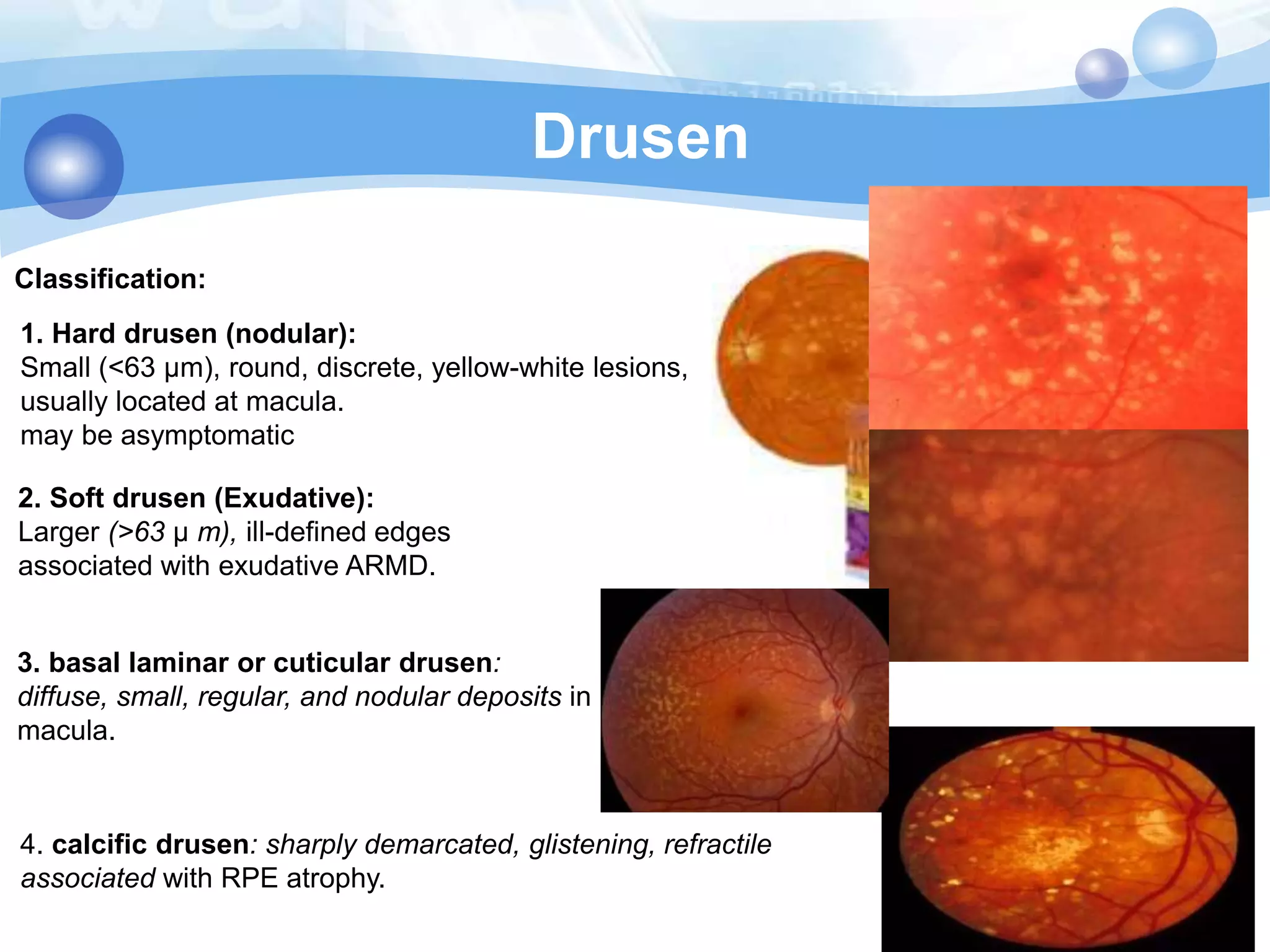 ARMD . How to detect ? | PPT