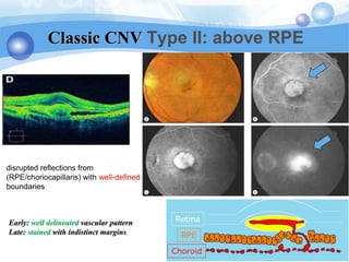 ARMD . How to detect ? | PPT