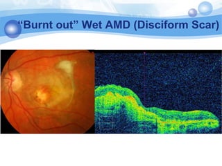 ARMD . How to detect ? | PPT