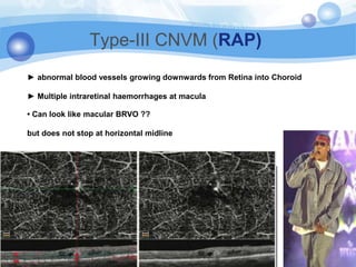 ARMD . How to detect ? | PPT