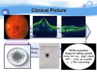 ARMD . How to detect ? | PPT