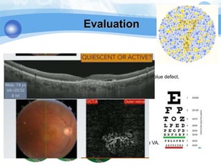 ARMD . How to detect ? | PPT