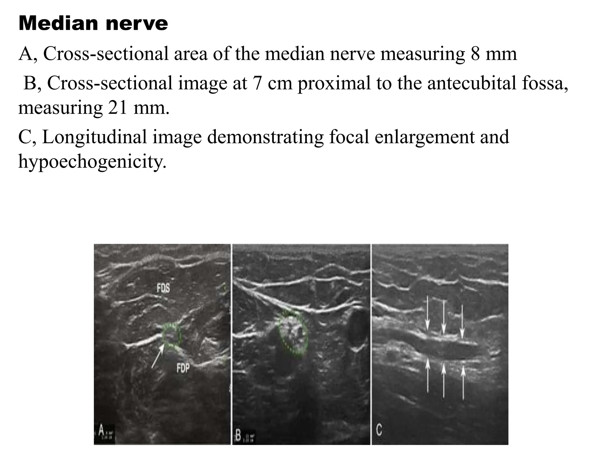Diagnosis of CIDP | PPT