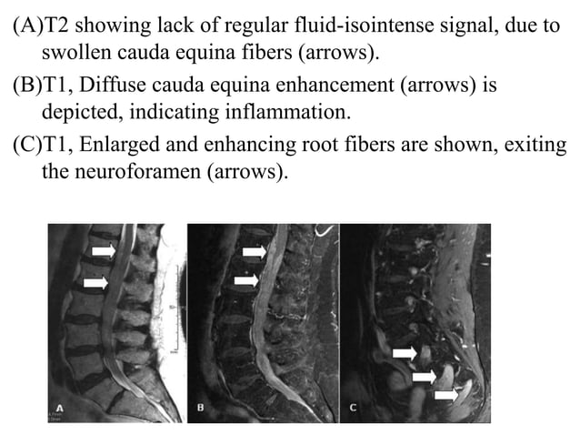Diagnosis of CIDP | PPT
