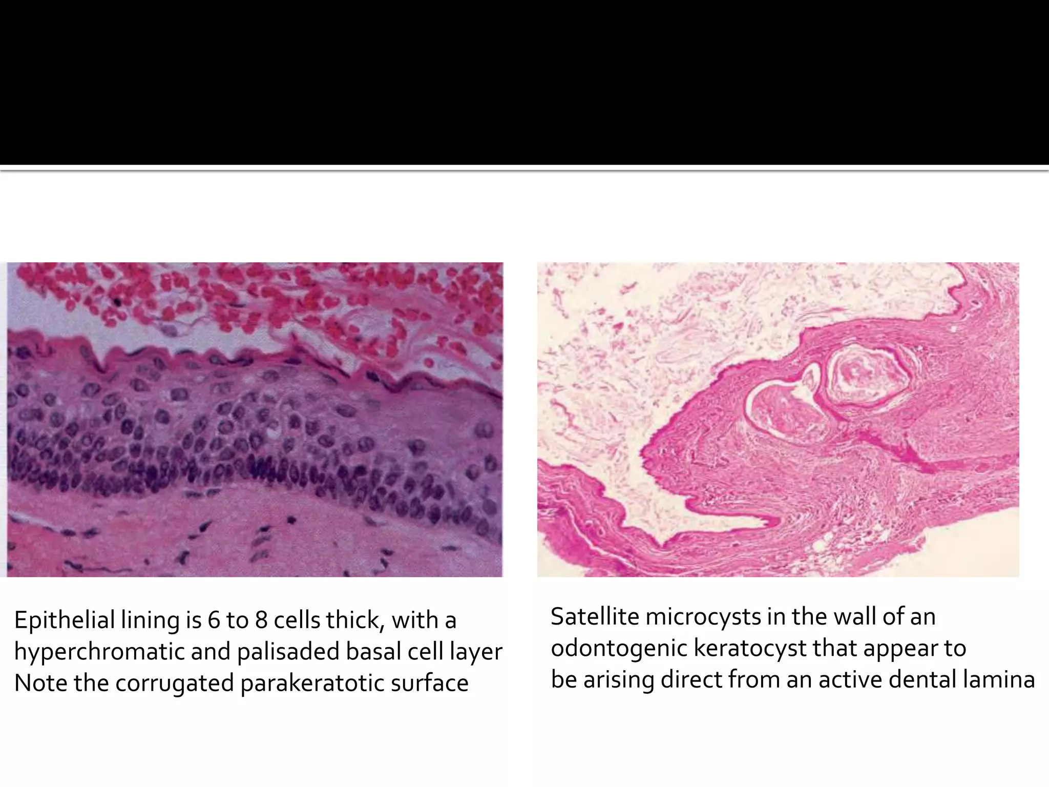 Diagnosis of cysts in oral cavity | PPTX