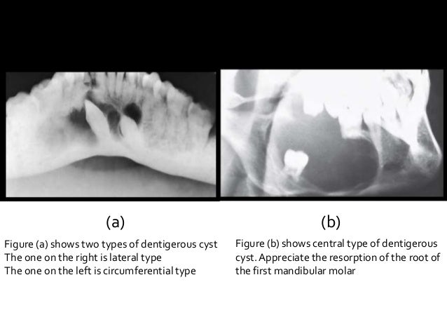 Radicular Cyst Radiology