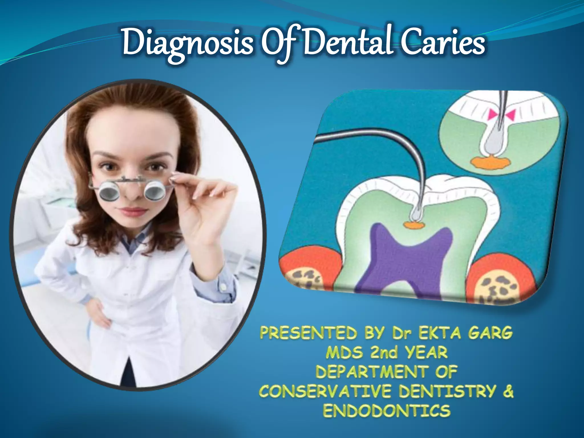 Diagnosis of dental caries | PPTX