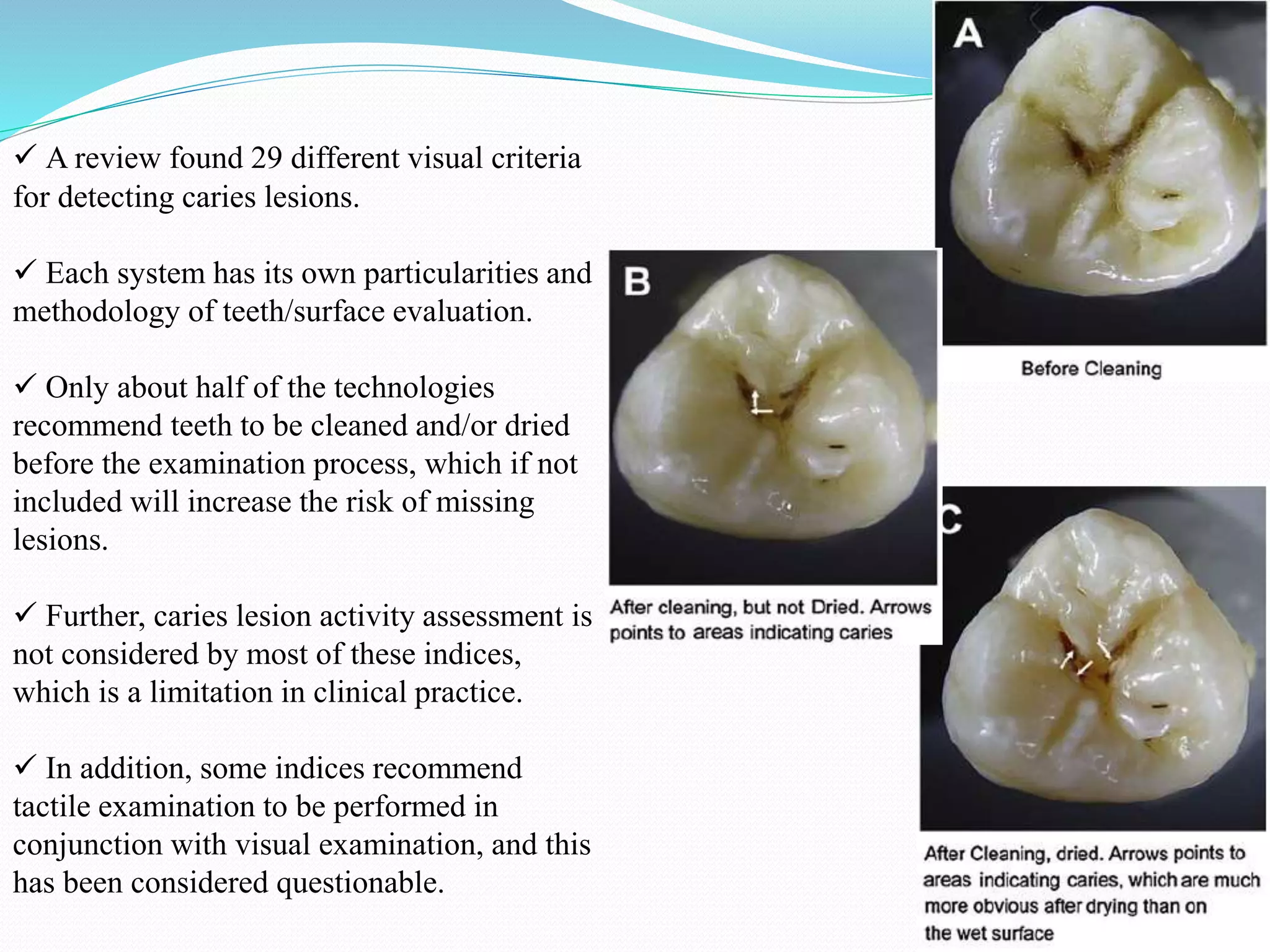 Diagnosis of dental caries | PPTX
