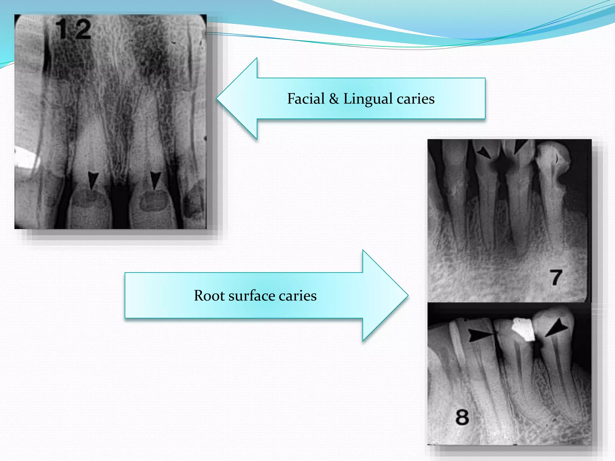 Diagnosis of dental caries | PPTX