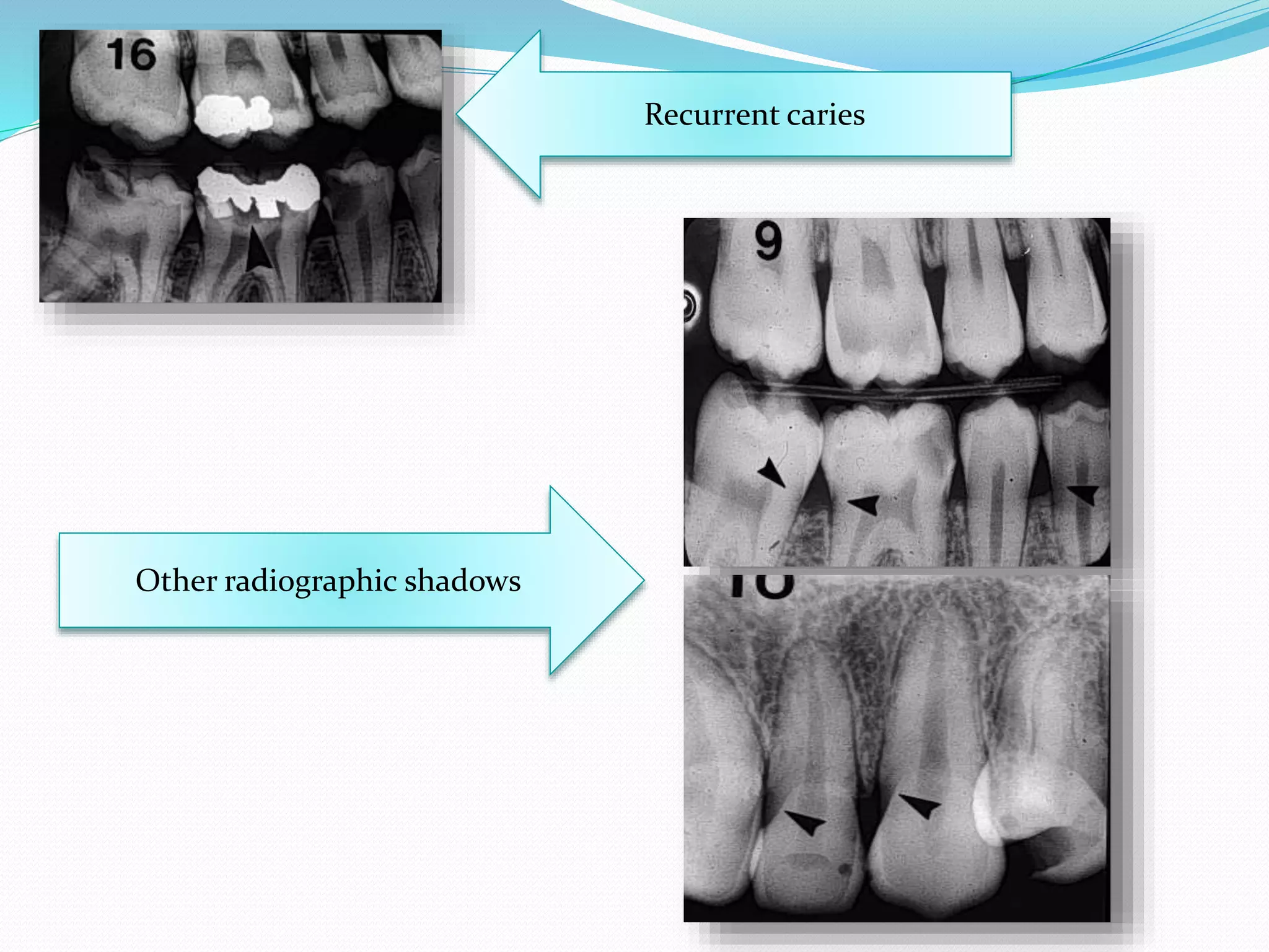 Diagnosis of dental caries | PPTX