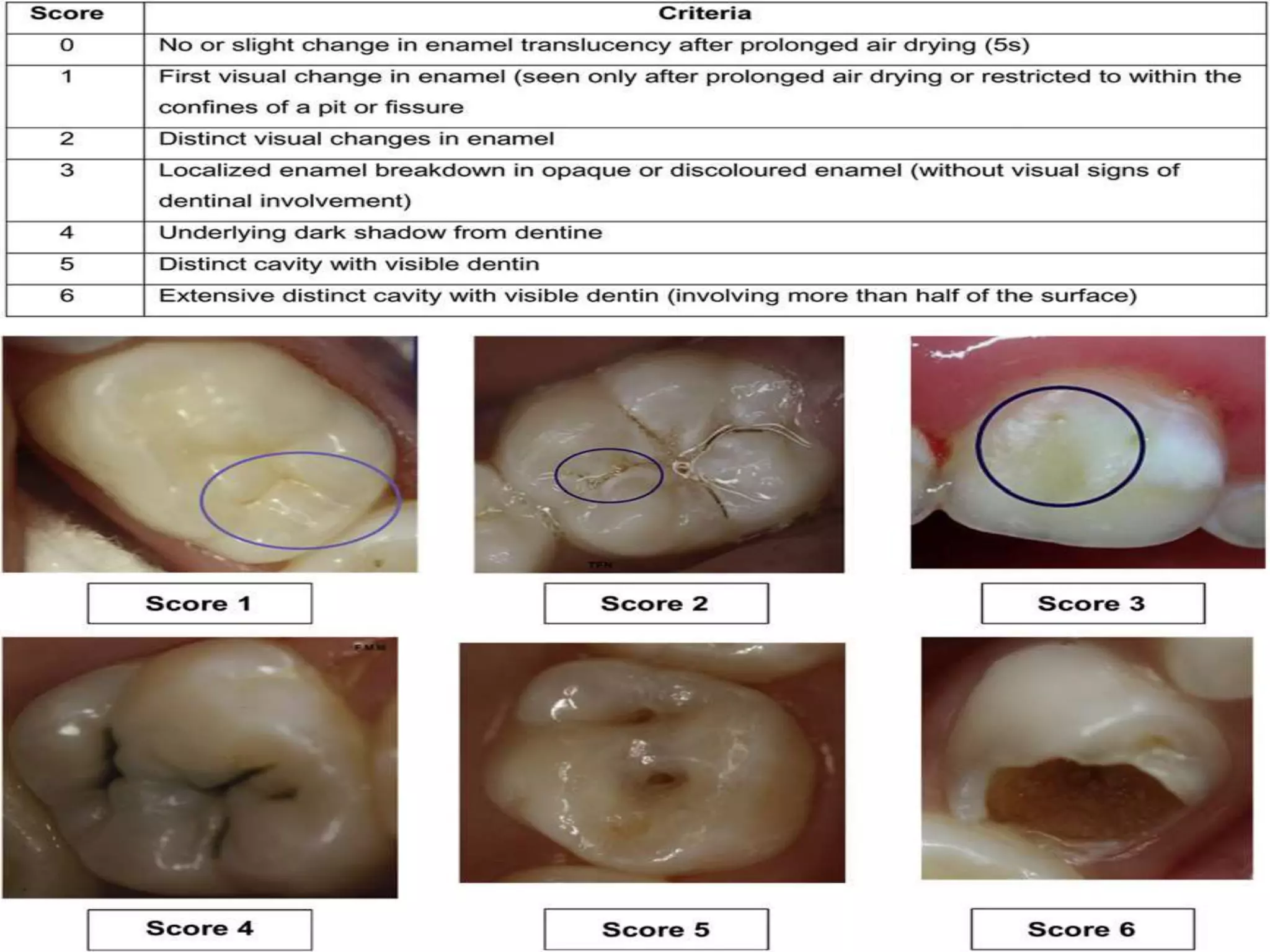 Diagnosis of dental caries