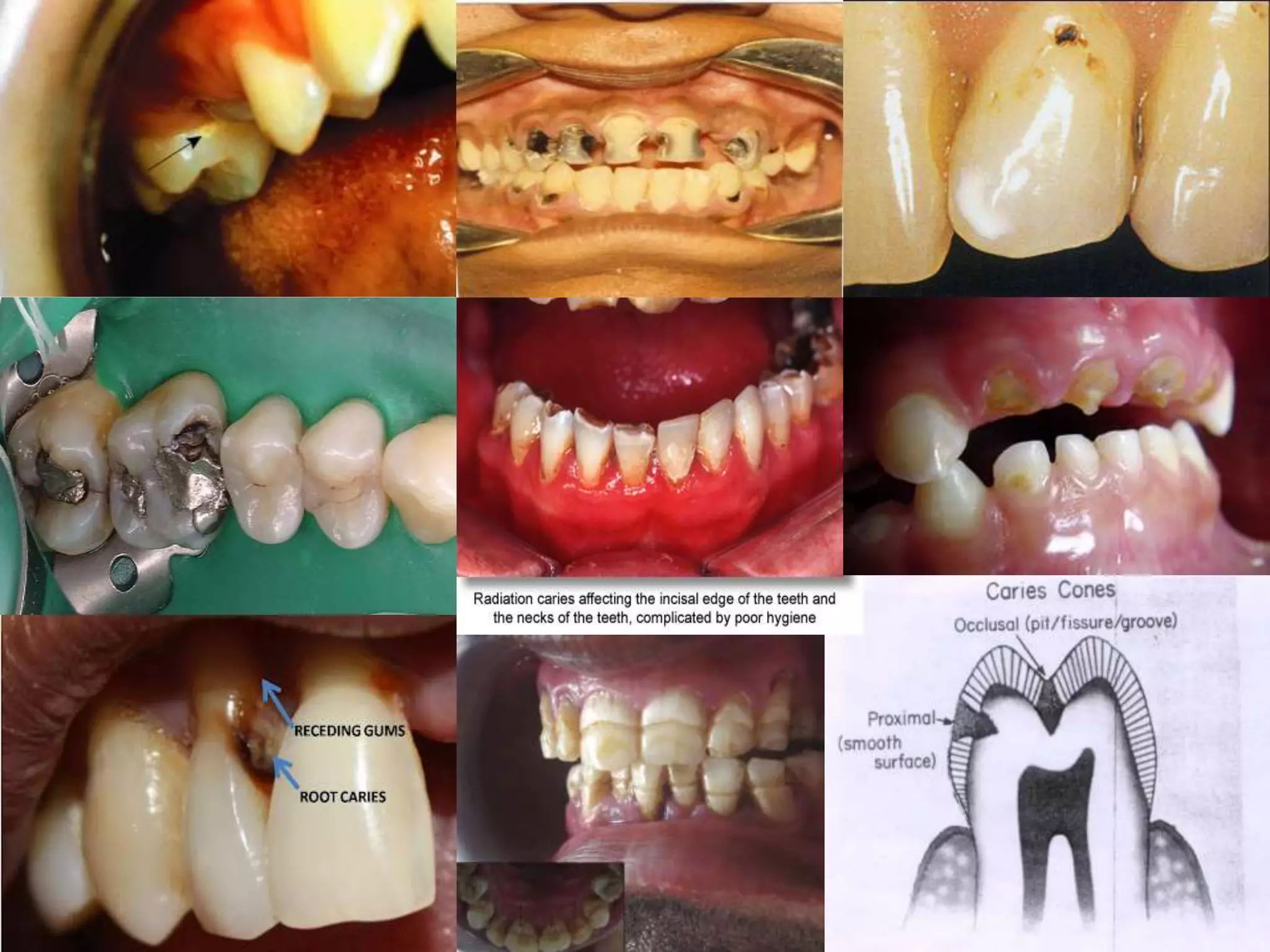 Diagnosis of dental caries