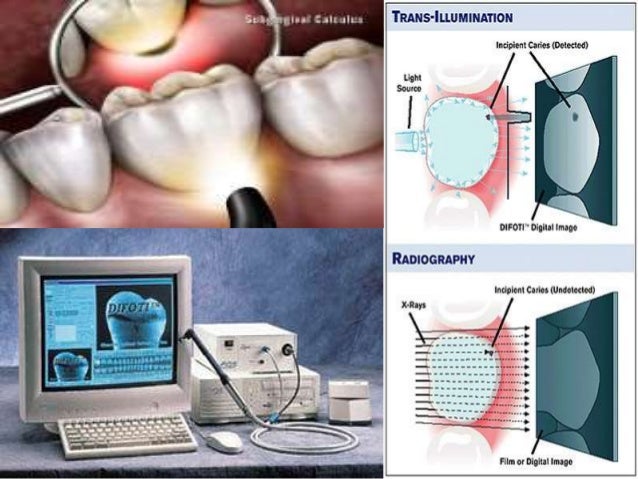 Diagnosis of dental caries
