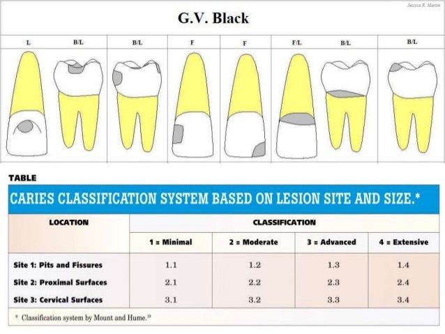 Icdas Caries Classification