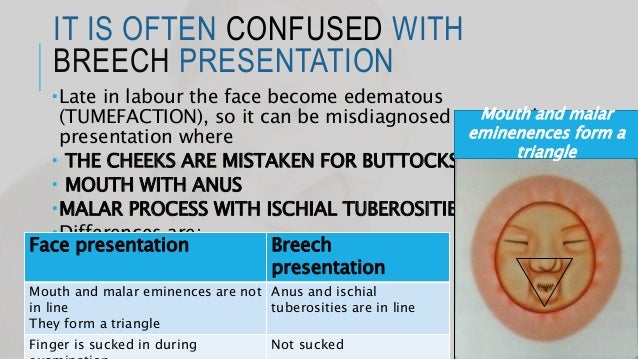 Diagnosis of face presentation