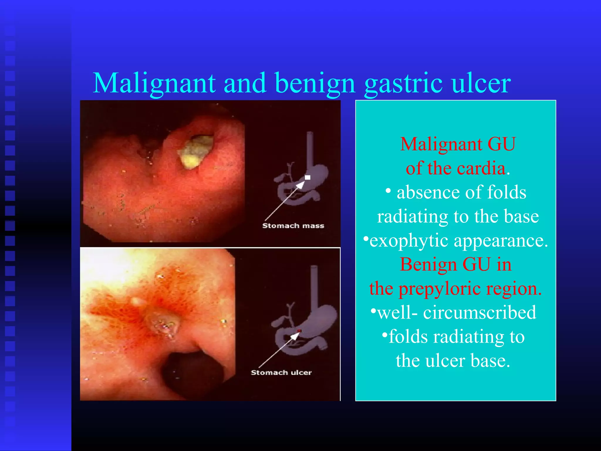 Diagnosis of gastric cancer | PPT