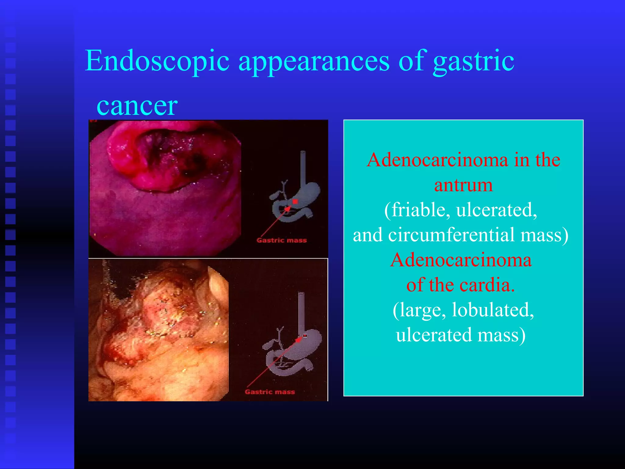 Diagnosis of gastric cancer | PPT