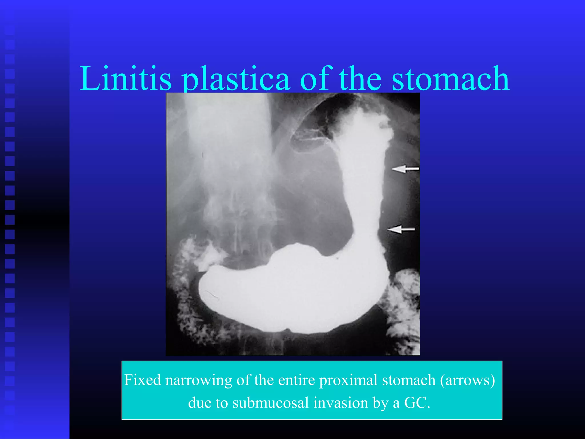Diagnosis of gastric cancer | PPT