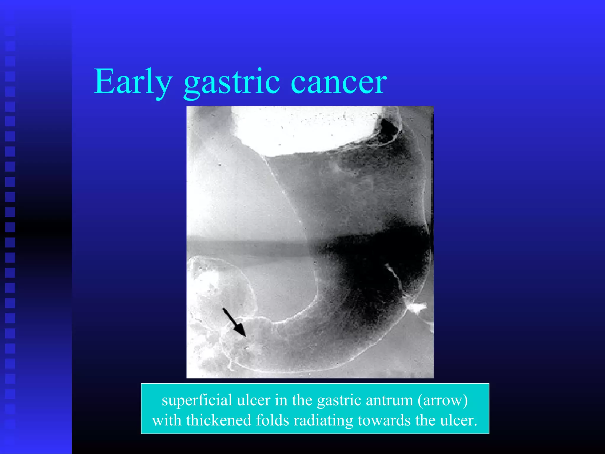 Diagnosis of gastric cancer | PPT