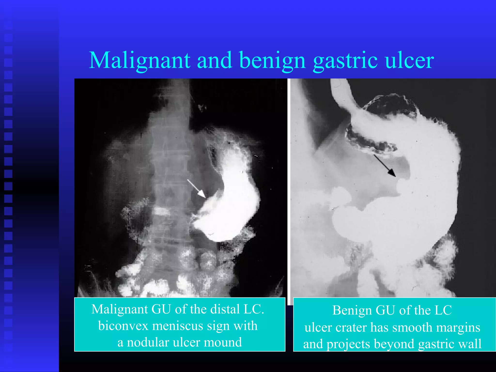 Diagnosis of gastric cancer | PPT