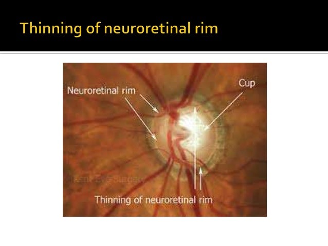Diagnosis of glaucoma