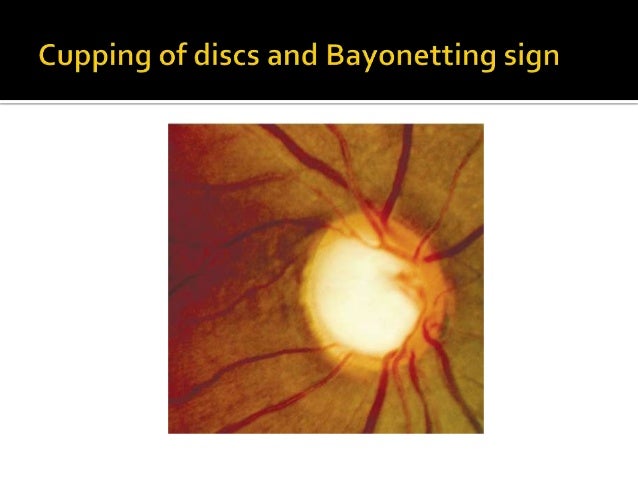 Diagnosis of glaucoma